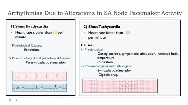 6- Cardiac Arrhythmias .pdf is a disease | PPT