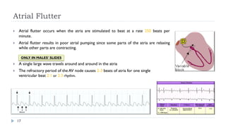 6- Cardiac Arrhythmias .pdf is a disease | PPT