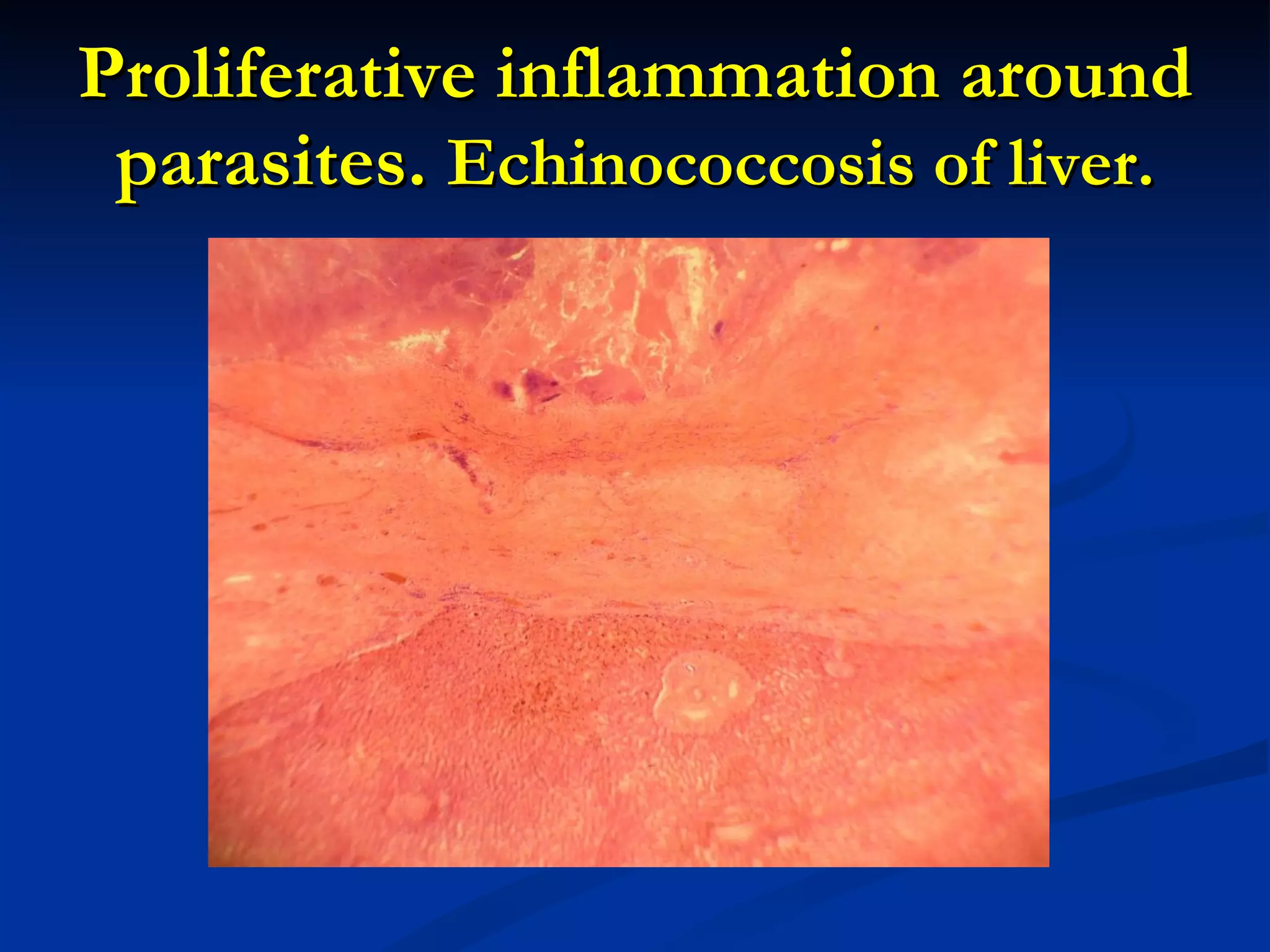 pat anat-chronic inflamation | PPT