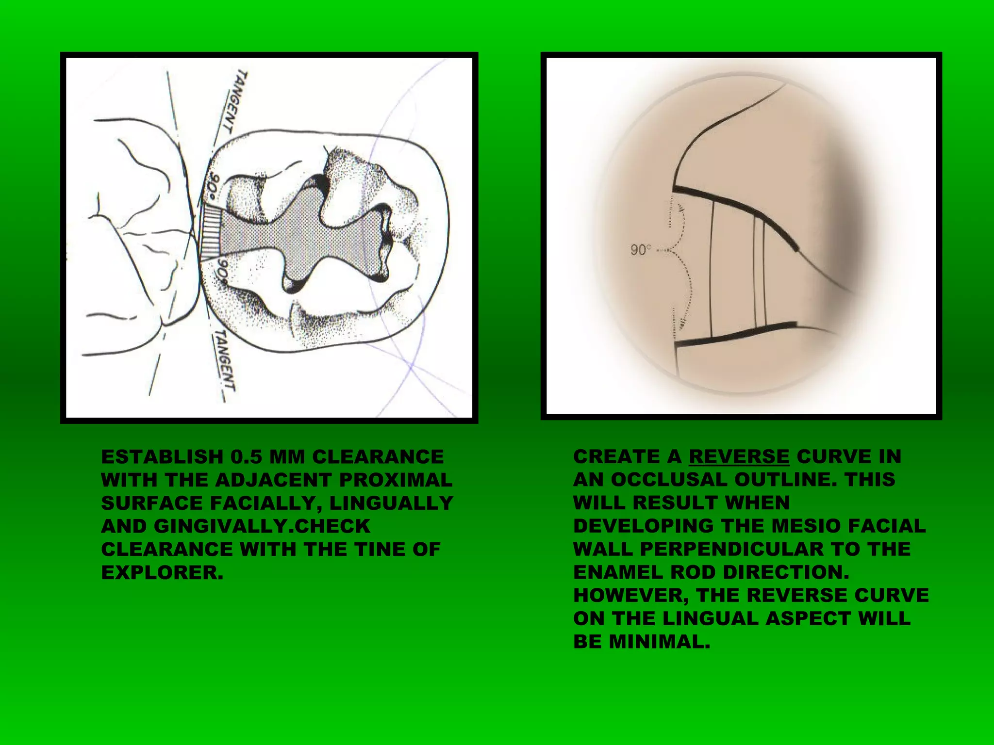 Class II Amalgam Preparation | PPT
