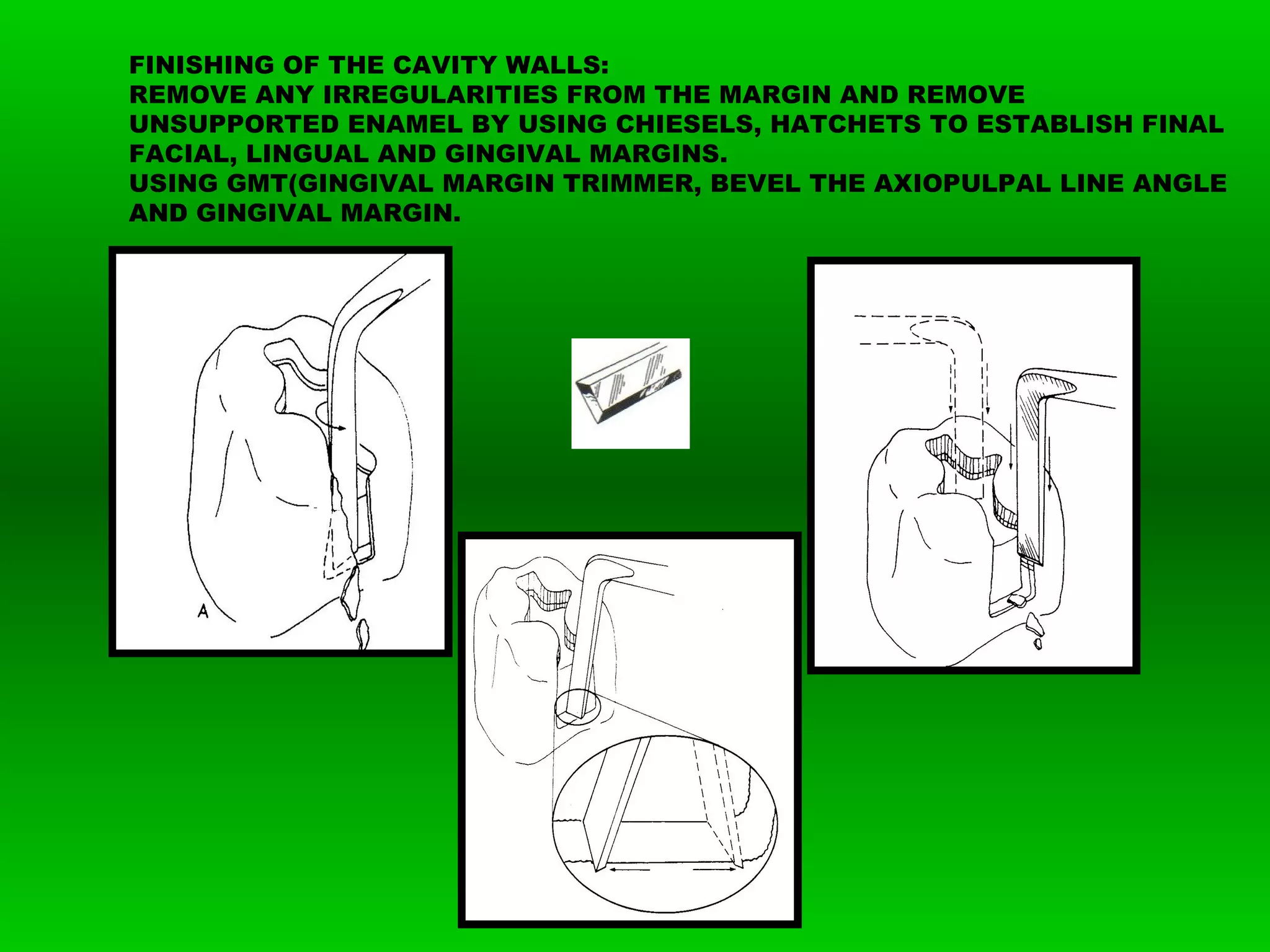 Class II Amalgam Preparation | PPT