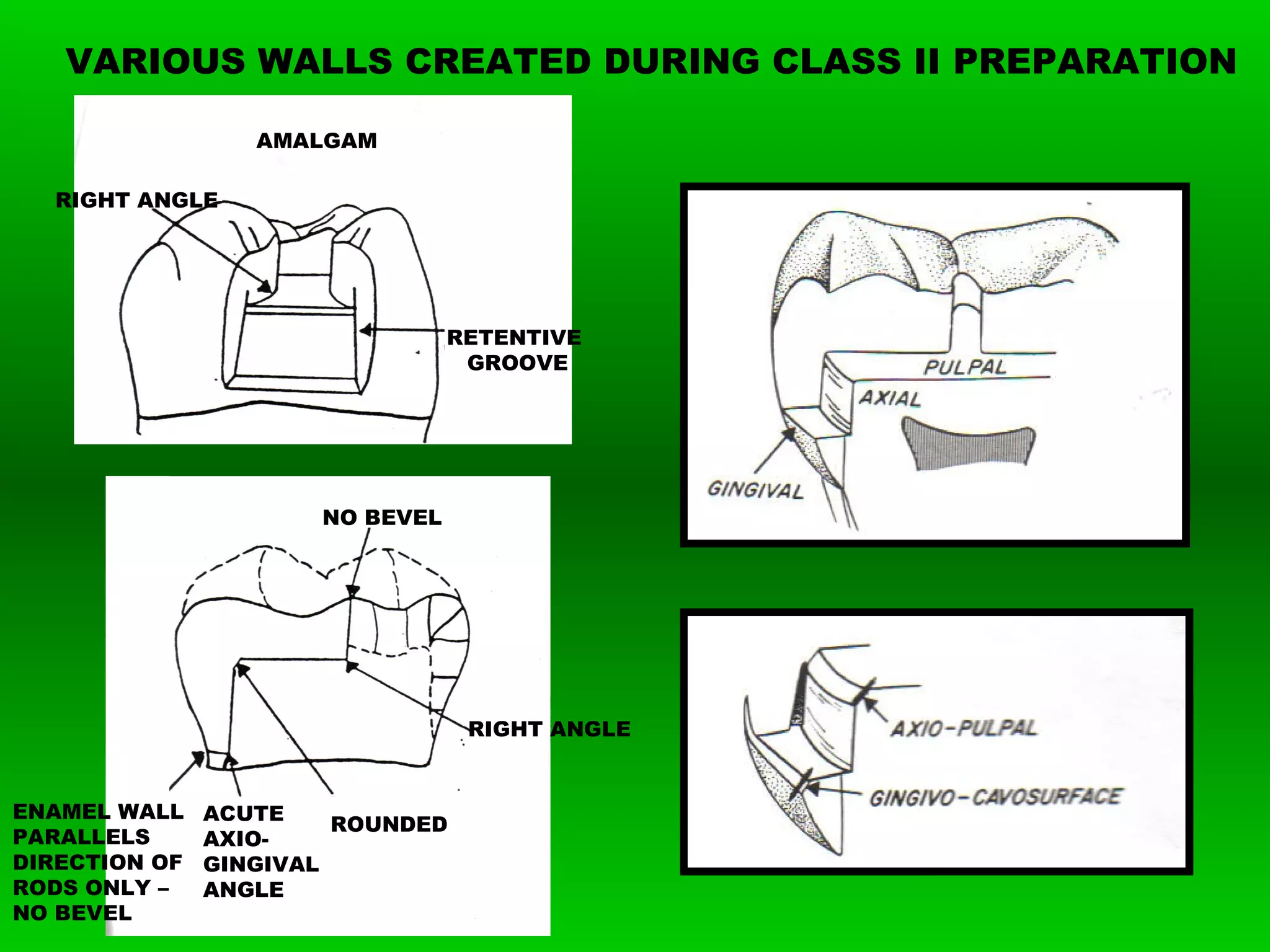 Class II Amalgam Preparation | PPT
