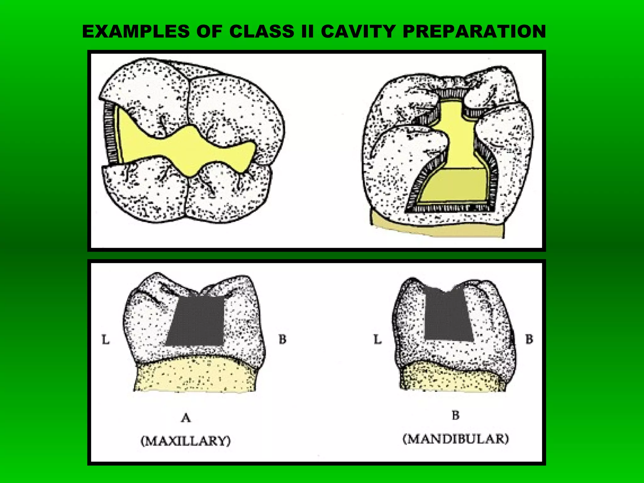 Class II Amalgam Preparation | PPT