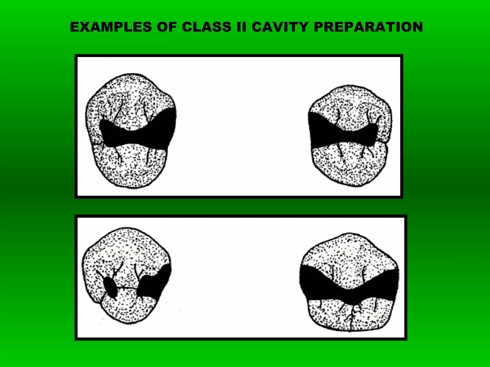 Class II Amalgam Preparation | PPT