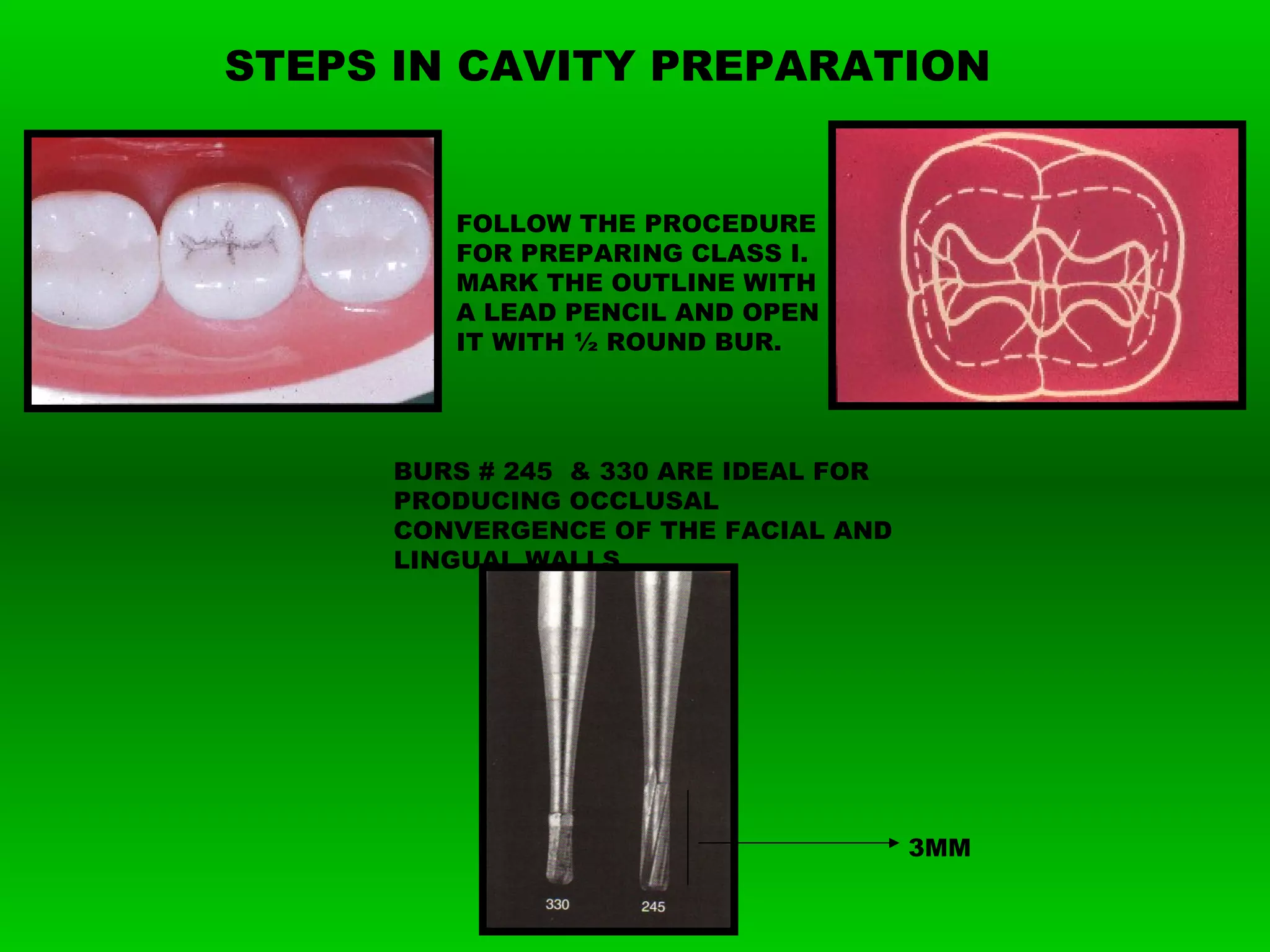 Class II Amalgam Preparation | PPT
