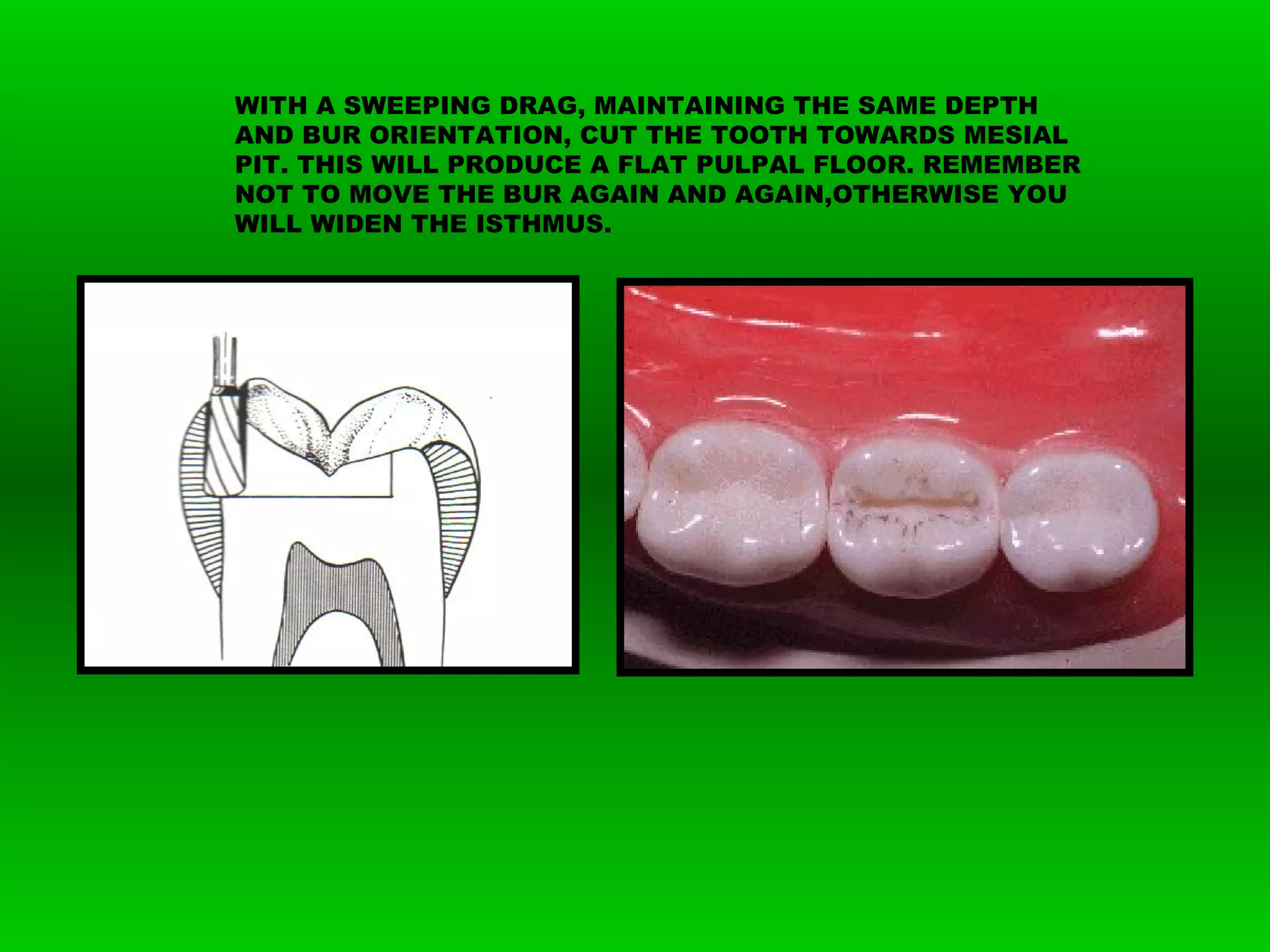 Class II Amalgam Preparation | PPT