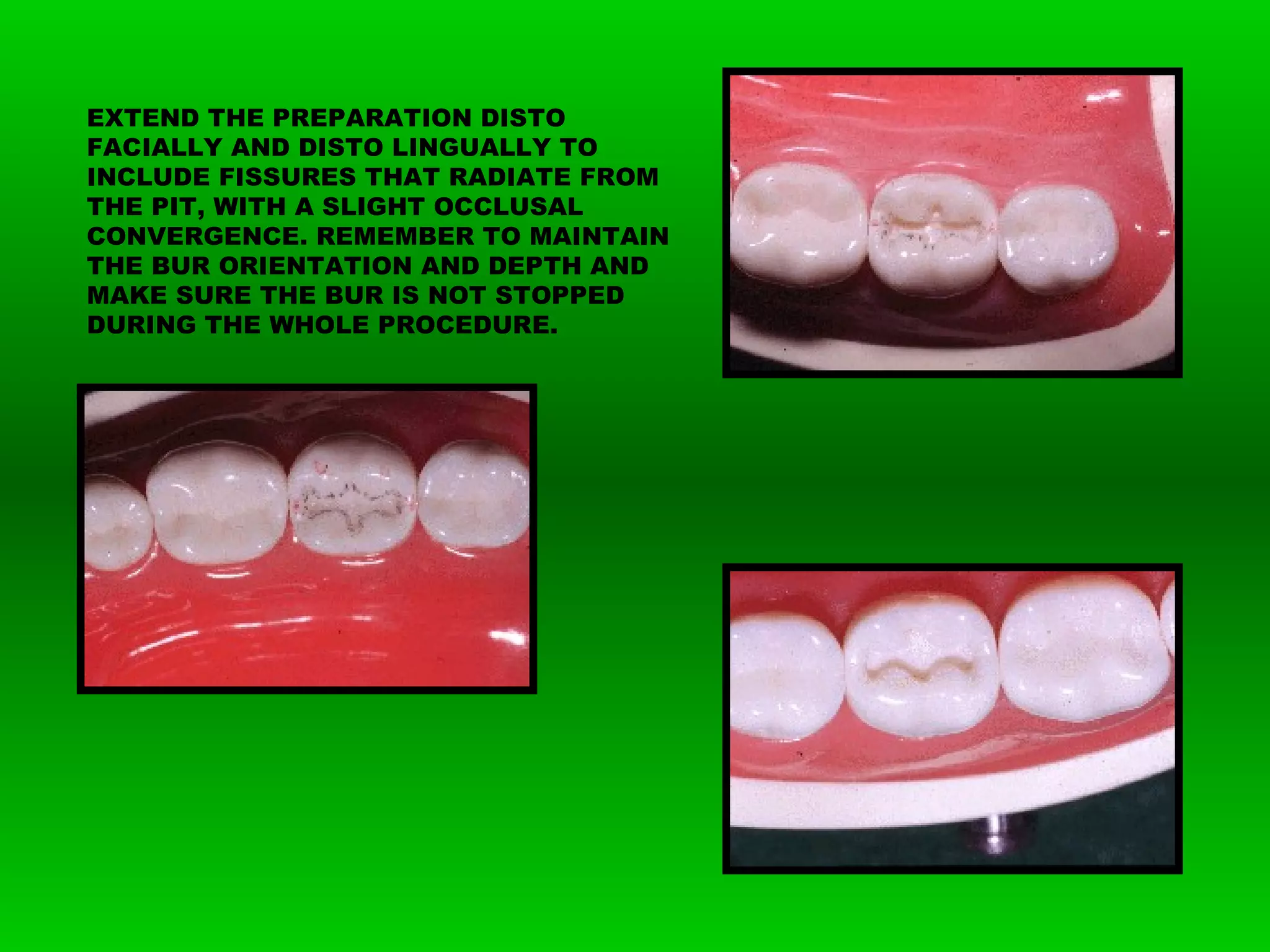 Class II Amalgam Preparation | PPT