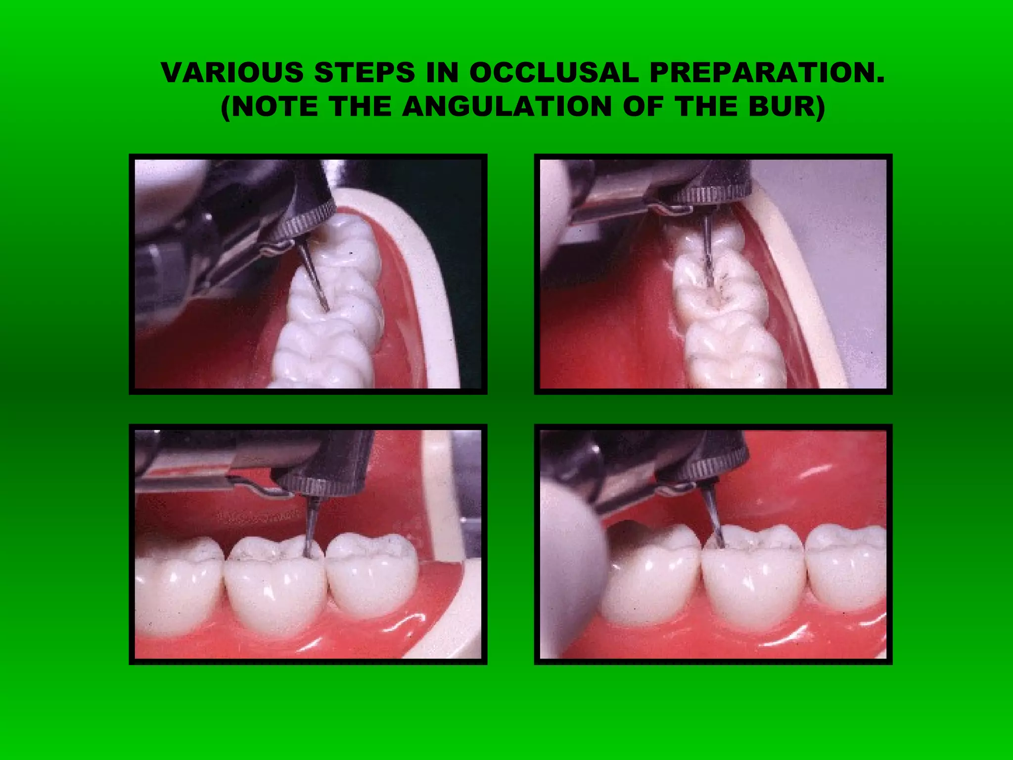 Class II Amalgam Preparation | PPT