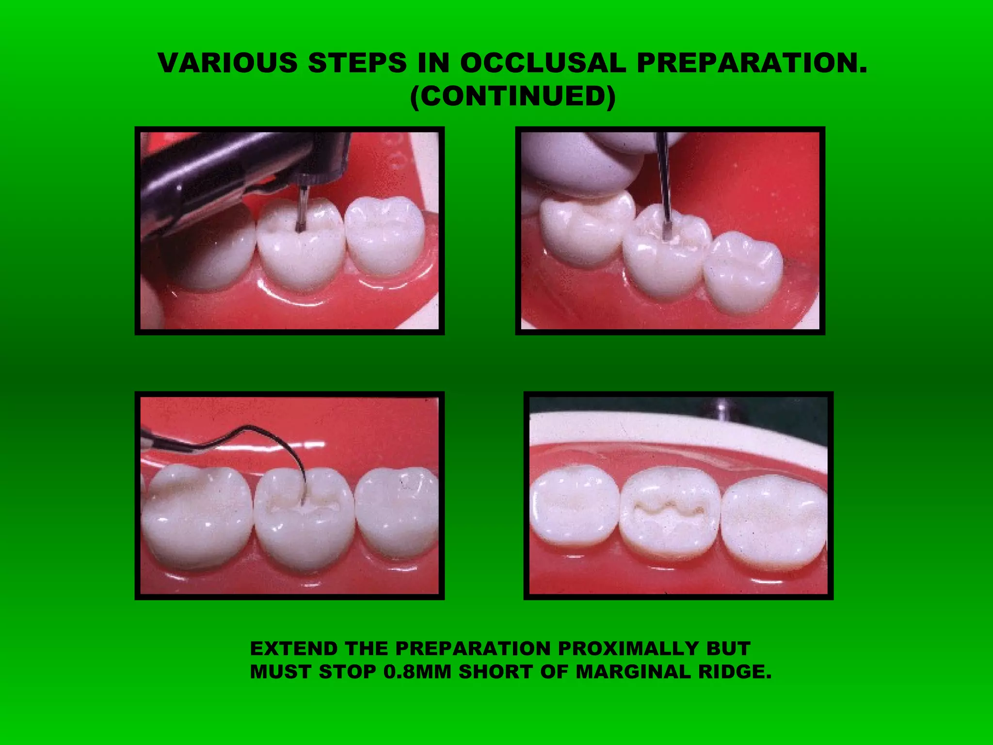 Class II Amalgam Preparation | PPT