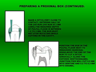 Class II Amalgam Preparation | PPT