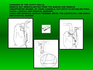 Class II Amalgam Preparation | PPT