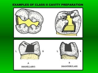 Class II Amalgam Preparation | PPT