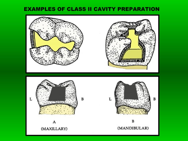 Class II Amalgam Preparation | PPT