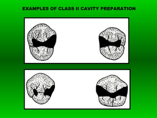 Class II Amalgam Preparation | PPT