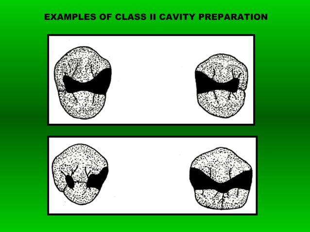 Class II Amalgam Preparation | PPT