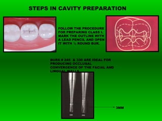 Class II Amalgam Preparation | PPT