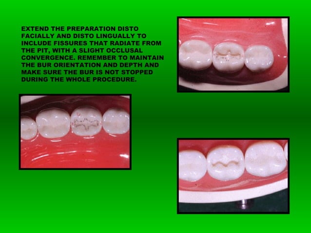Class II Amalgam Preparation | PPT