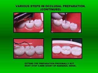 Class II Amalgam Preparation | PPT