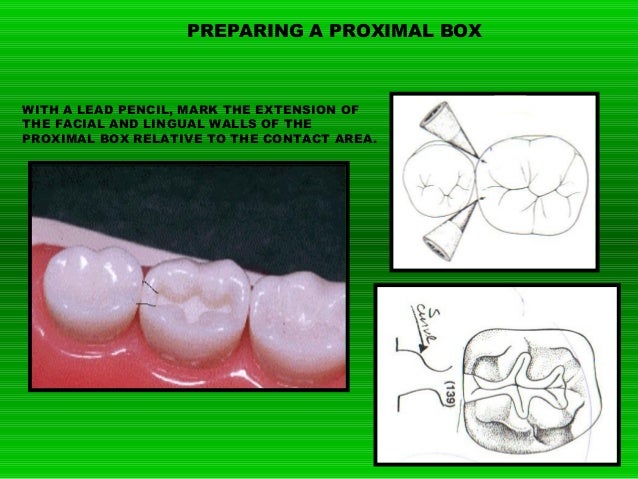 Class II Amalgam Preparation