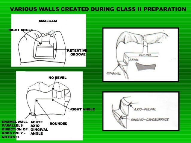 Class II Amalgam Preparation
