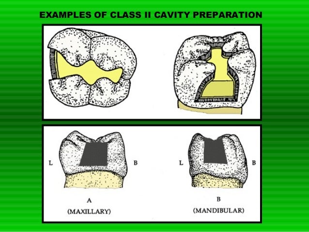 Class II Amalgam Preparation