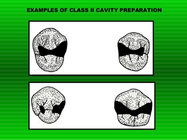 Class II Amalgam Preparation
