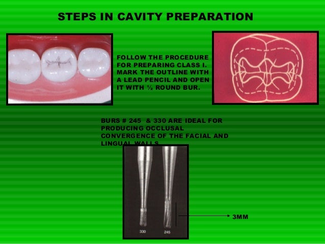 Class II Amalgam Preparation