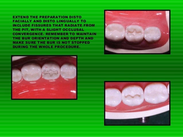 Class II Amalgam Preparation