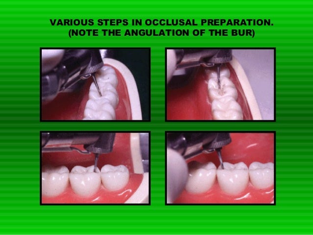 Class II Amalgam Preparation