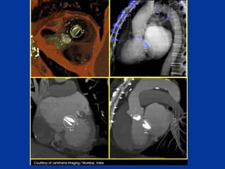 Chapter 6- Chest & Cardiovascular radiology.pdf