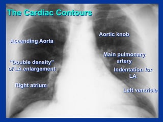 Chapter 6- Chest & Cardiovascular radiology.pdf
