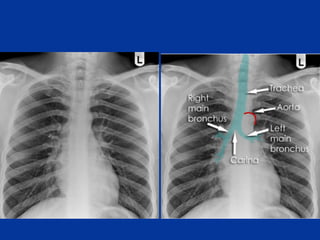 Chapter 6- Chest & Cardiovascular radiology.pdf