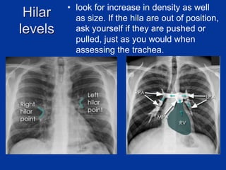 Chapter 6- Chest & Cardiovascular radiology.pdf
