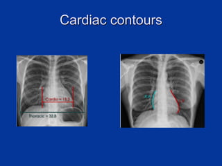 Chapter 6- Chest & Cardiovascular radiology.pdf