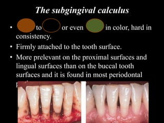 Subgingival Calculus