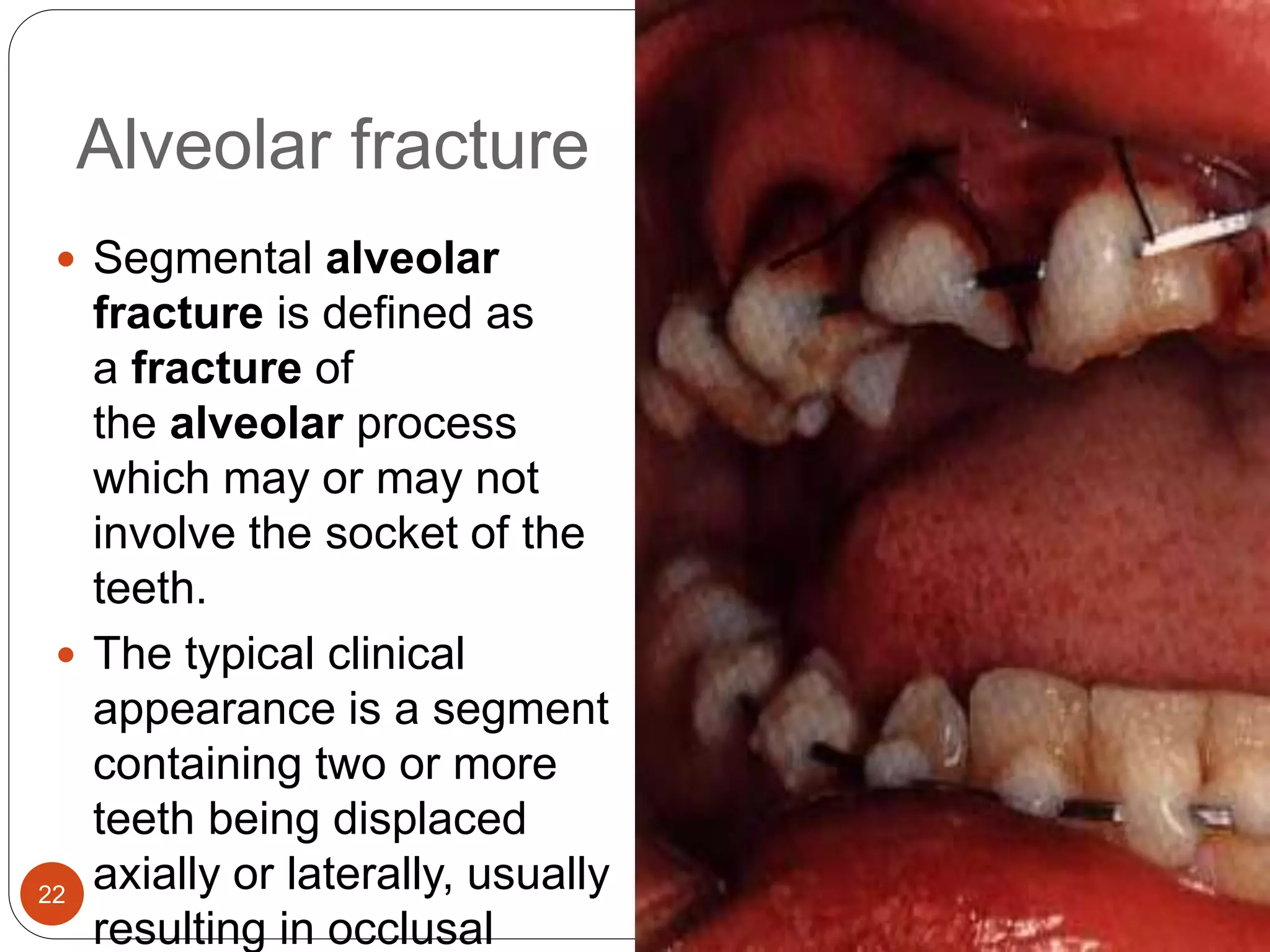 6-Dento-alveolar fractures.ppt