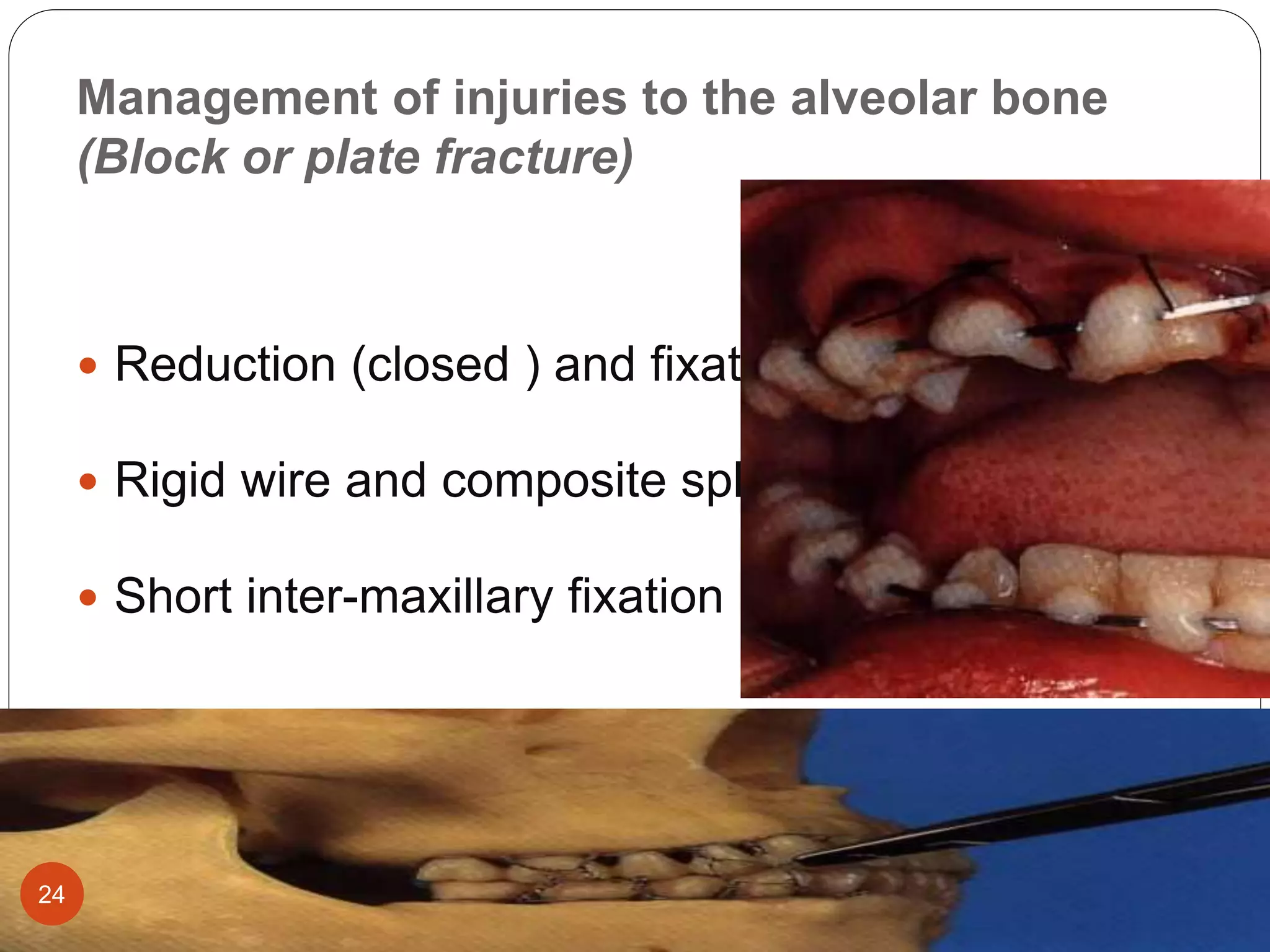 6-Dento-alveolar fractures.ppt