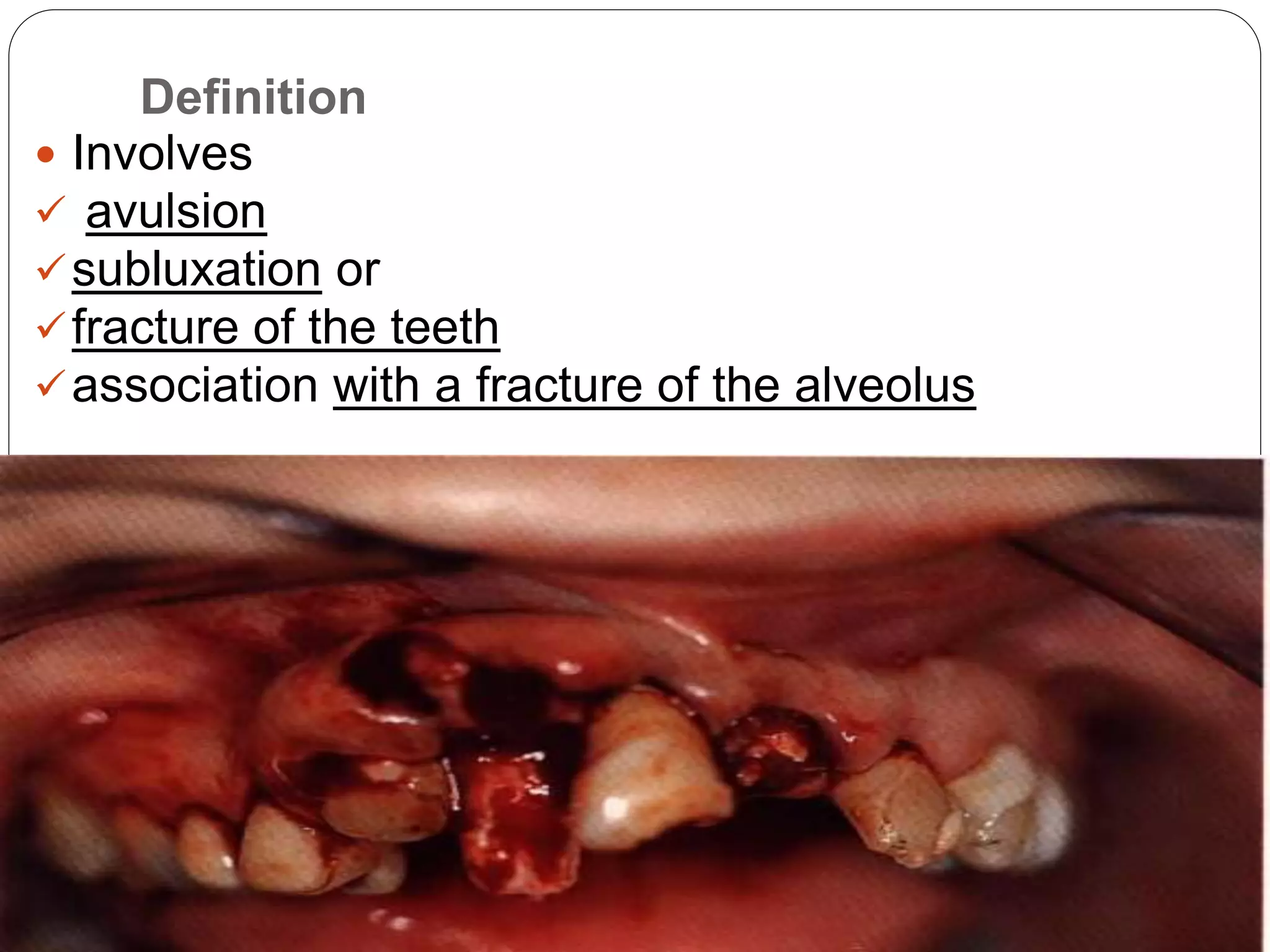 6-Dento-alveolar fractures.ppt