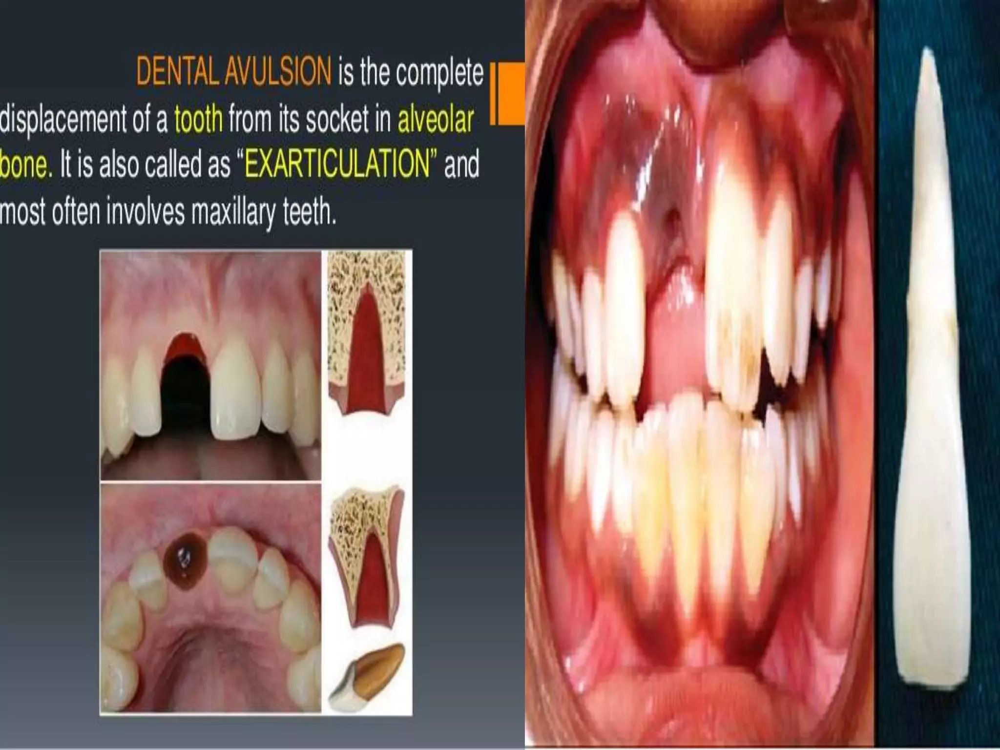 6-Dento-alveolar fractures.ppt
