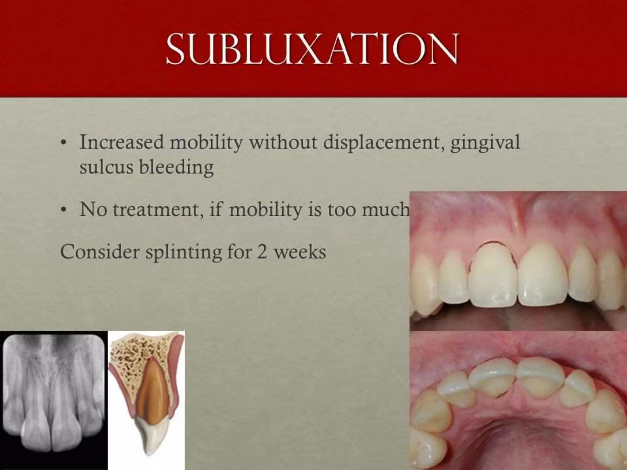 6-Dento-alveolar fractures.ppt