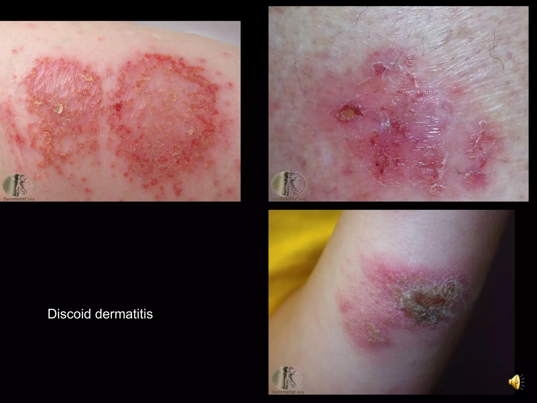 6. dermatitis and its variants | PPT