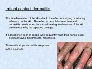 6. dermatitis and its variants | PPT