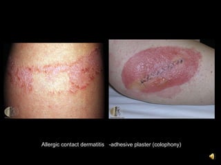 6. dermatitis and its variants | PPT
