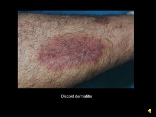6. dermatitis and its variants | PPT