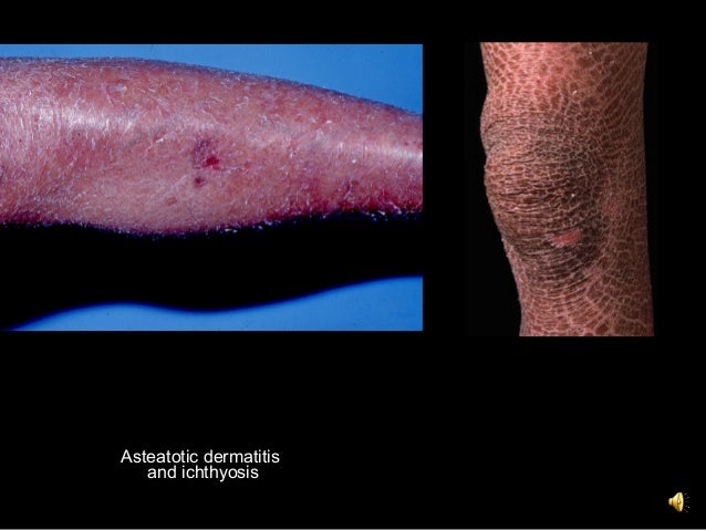 6. dermatitis and its variants