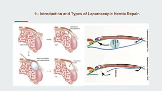 Lap. Tapp Made Easy Using The Innovative Tumescent Technique | PPTX