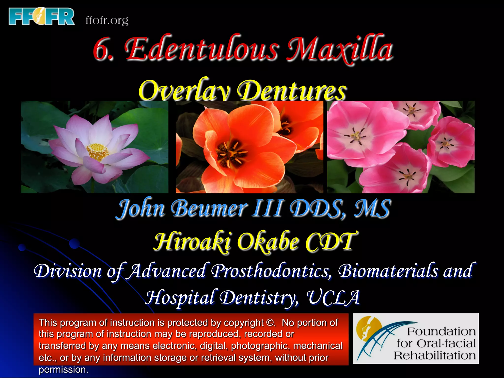 Edentulous Maxilla - Overlay Dentures | PDF
