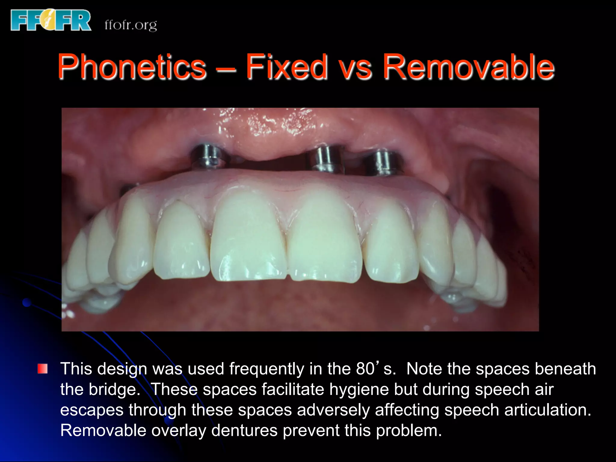 Edentulous Maxilla - Overlay Dentures | PDF