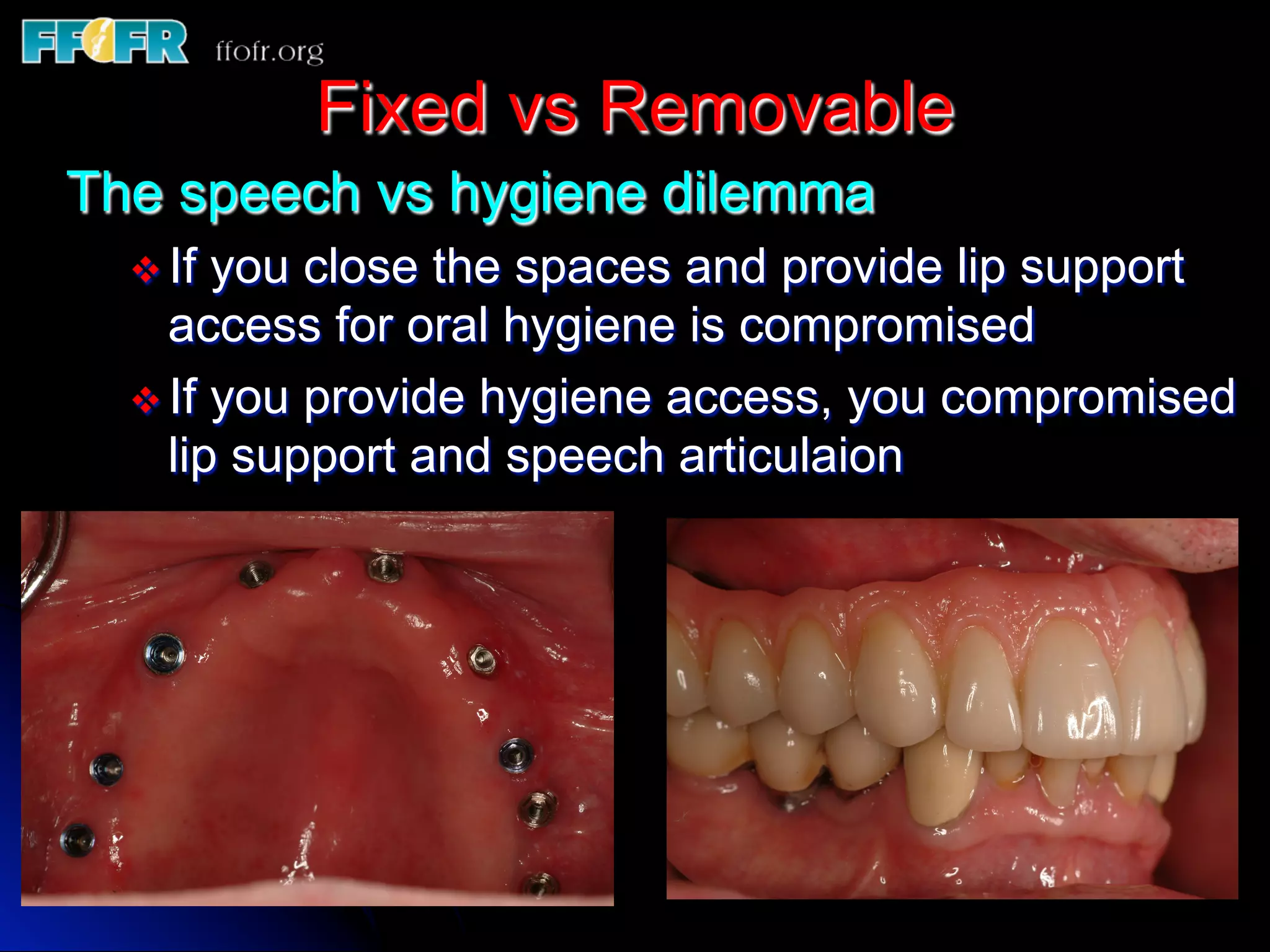 Edentulous Maxilla - Overlay Dentures | PDF