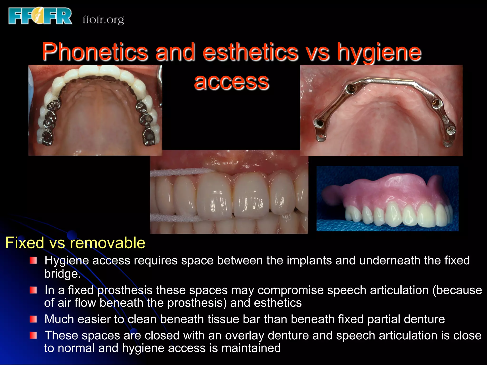 Edentulous Maxilla - Overlay Dentures | PDF